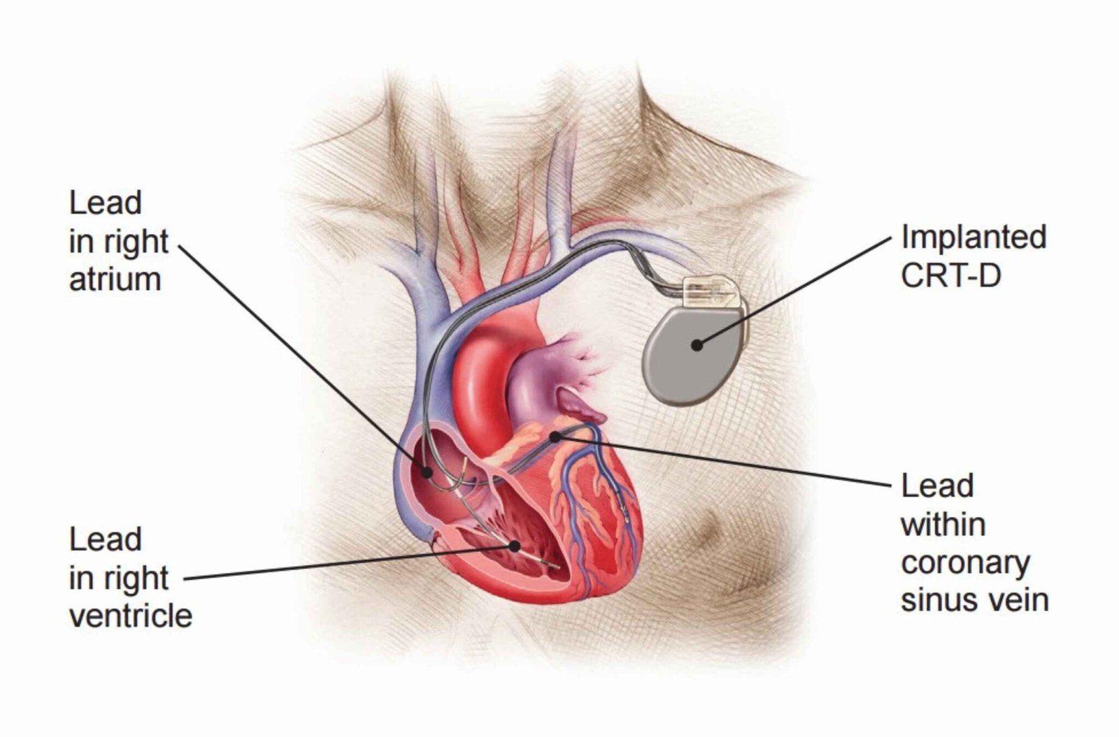Cardiac Resynchronization Therapy Defibrillator - Dr Amit Patil